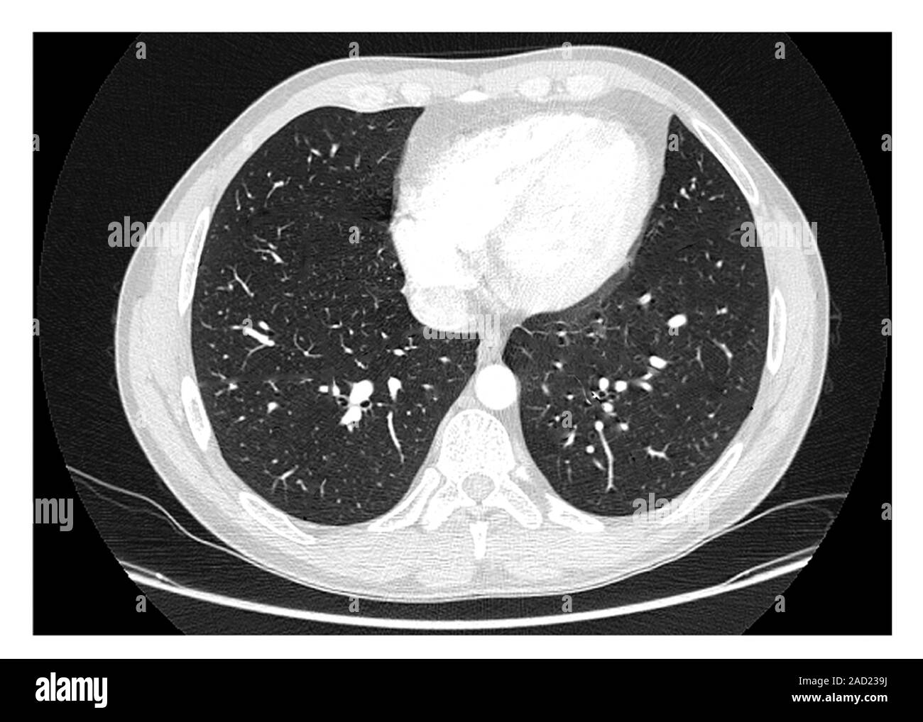 Illustration des poumons, la segmentation pulmonaire thoracique en CT ...
