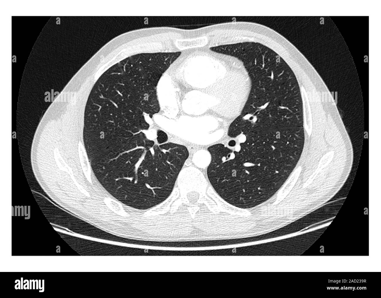 Illustration des poumons, la segmentation pulmonaire thoracique en CT ...