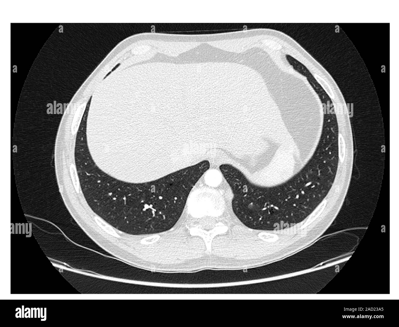 Illustration des poumons, la segmentation pulmonaire thoracique en CT ...