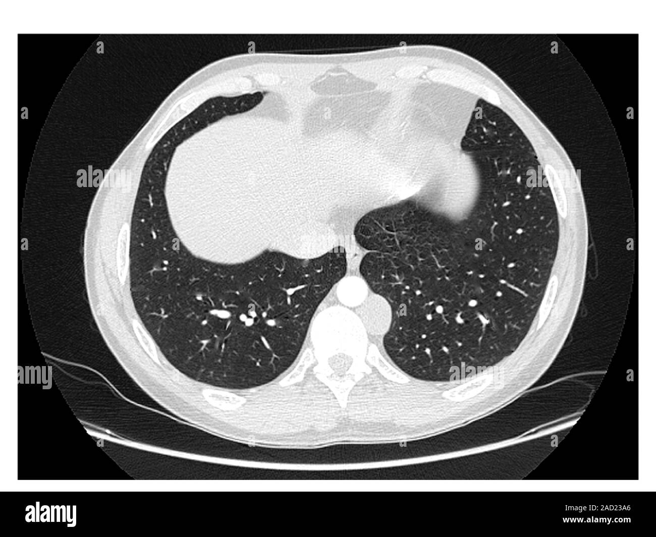 Illustration des poumons, la segmentation pulmonaire thoracique en CT ...