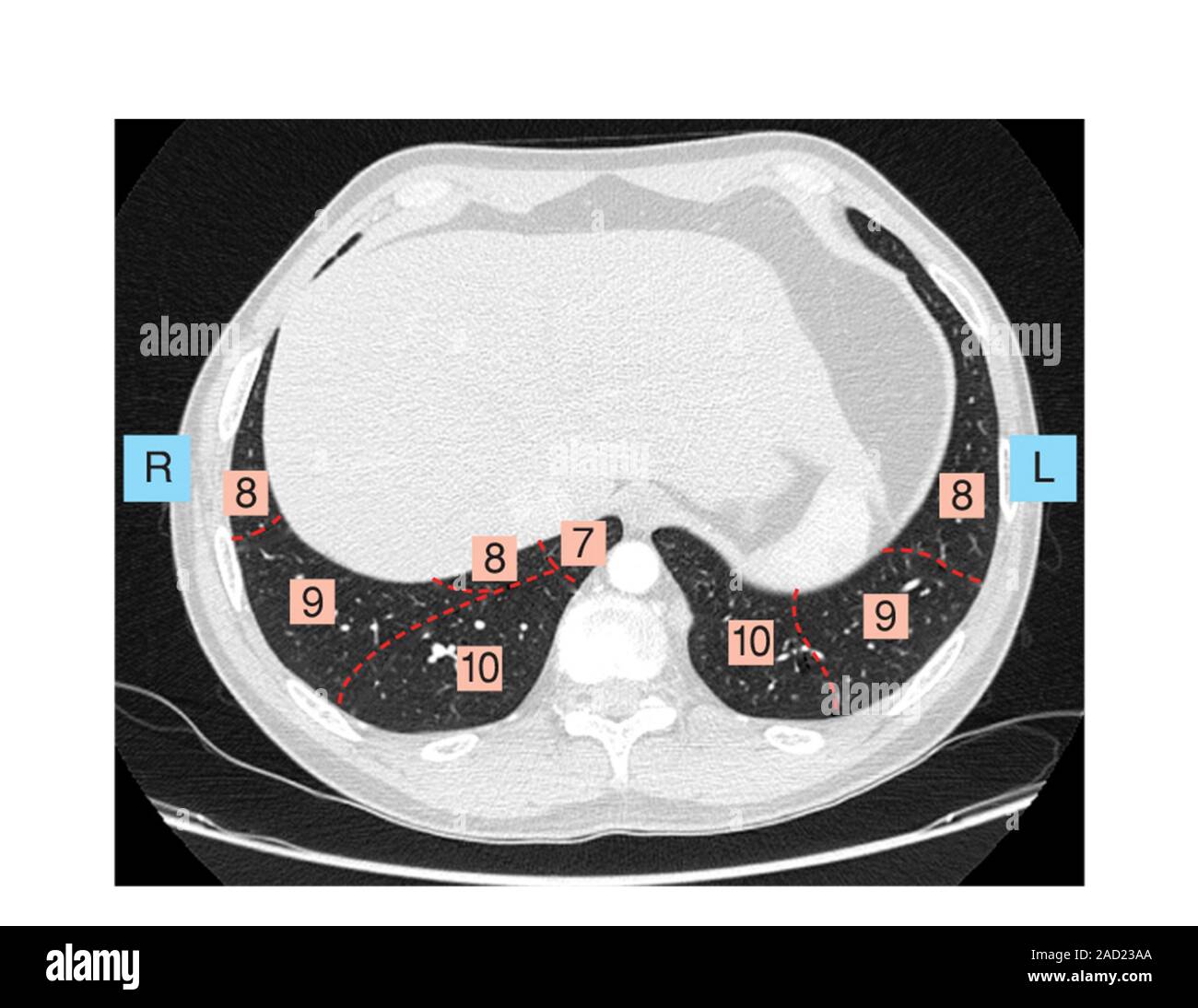Illustration des poumons, la segmentation pulmonaire thoracique en CT ...