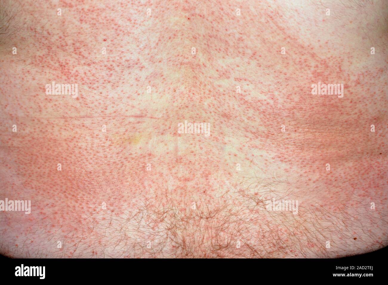 L'urticaire cholinergique. Close-up de l'urticaire sur le corps d'un 33 ...