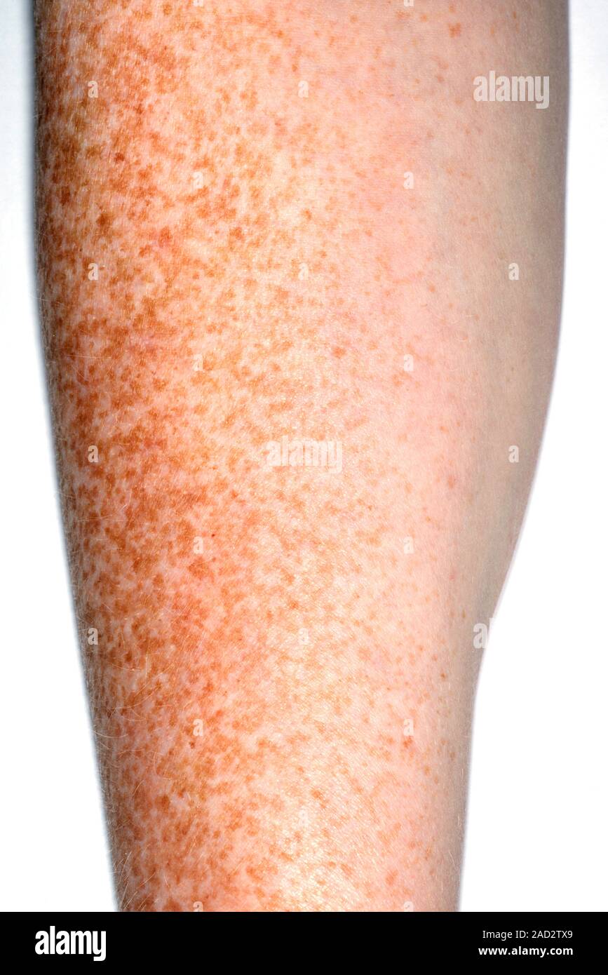 Thrombophlébite superficielle. Close-up de la jambe d'un 49-year-old ...