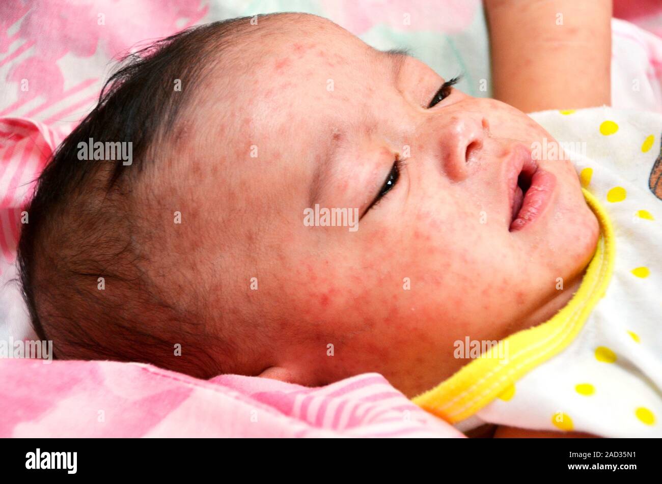 La rougeole. Close-up d'un bébé avec une éruption sur son visage dues à ...