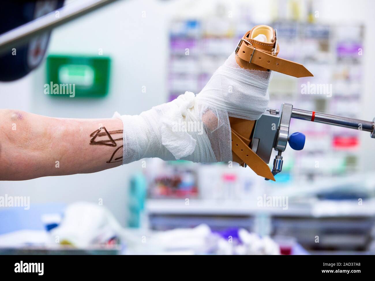 Les préparatifs de la chirurgie orthopédique. Pied du patient attaché ...