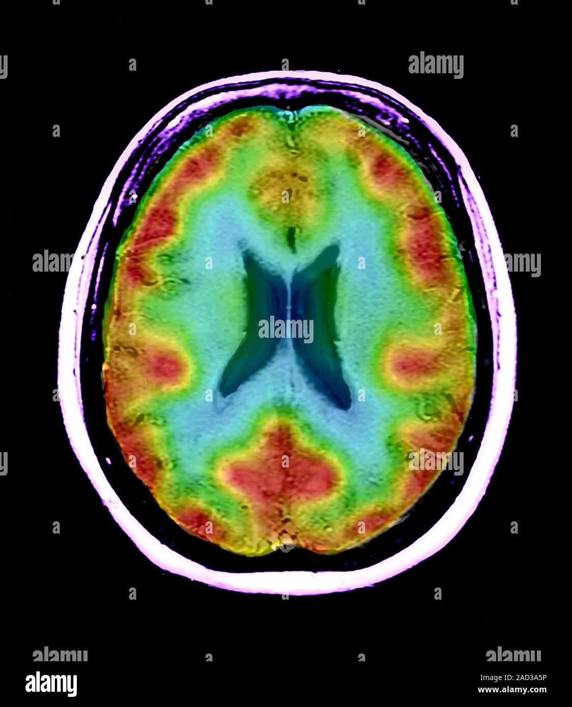 Le débit sanguin normal du cerveau. Couleur composite de l'imagerie par résonance magnétique ...
