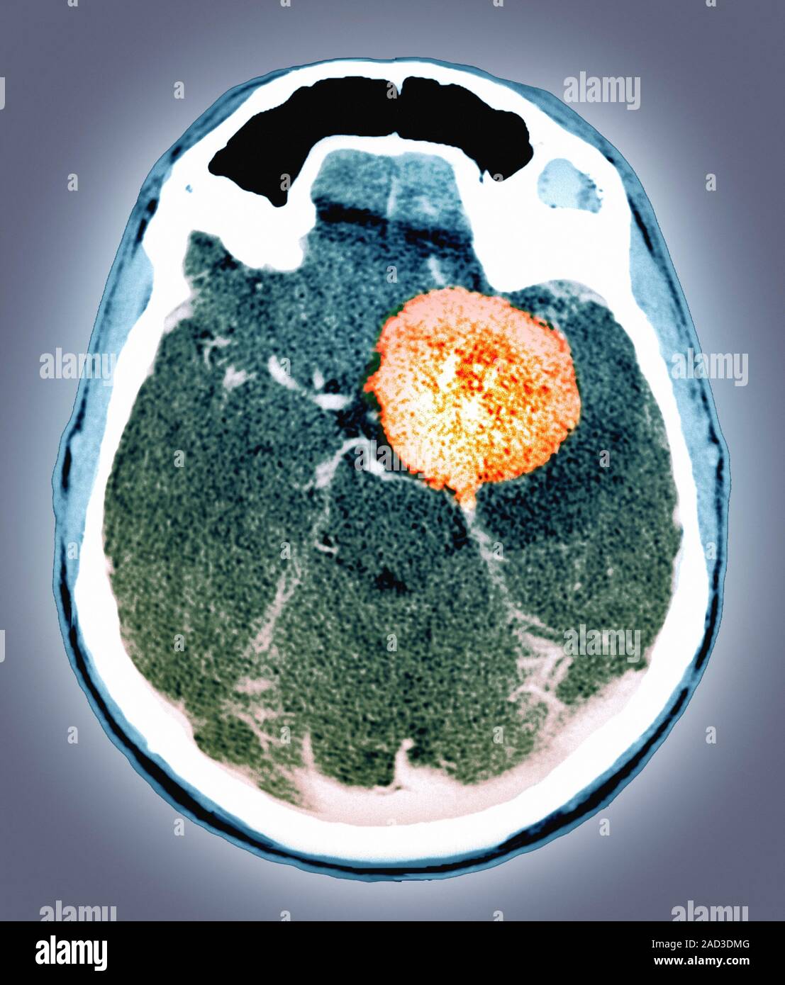 Tumeur au cerveau. La tomographie de couleur (CT) d'une section à travers le chef de 42 ans ...