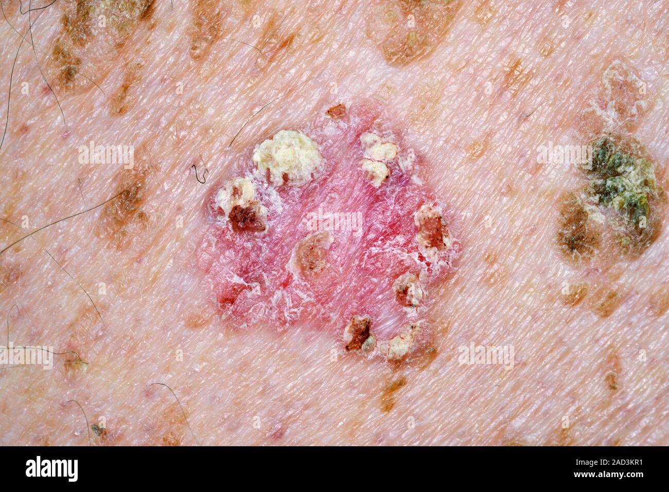 La maladie de Bowen cancer de la peau. Close-up d'une lésion ulcérée ...