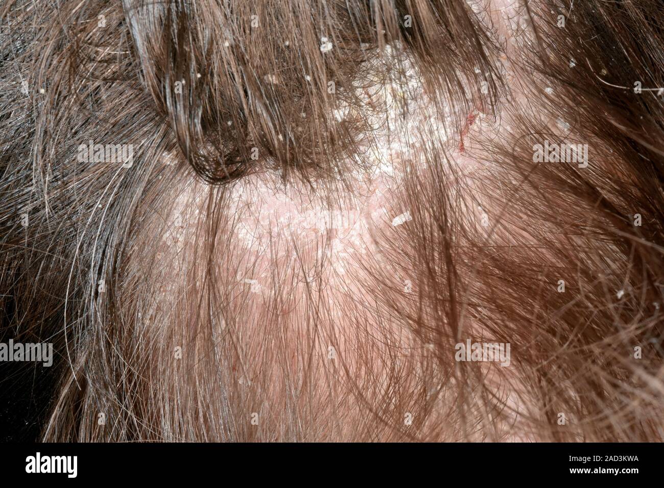 Pellicules dans la dermatite séborrhéique. Close-up du cuir chevelu d ...