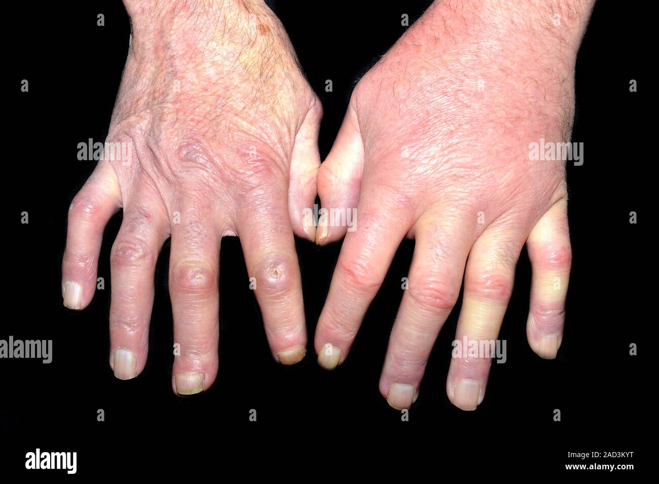 Dans la sclérodermie vascularites et le SARM. Close-up de la main d'un ...