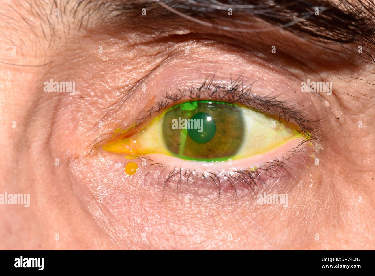 L'abrasion de la cornée. Close-up de l'oeil d'un 59-year-old female ...