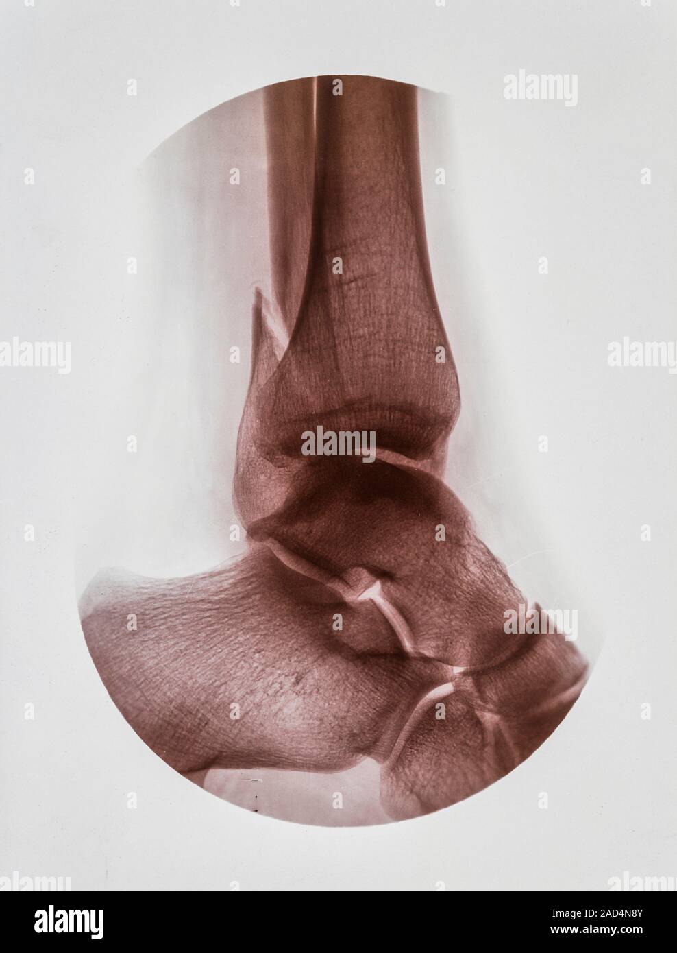 Fracture de la cheville X-ray. Cette radiographie est d'une collection ...