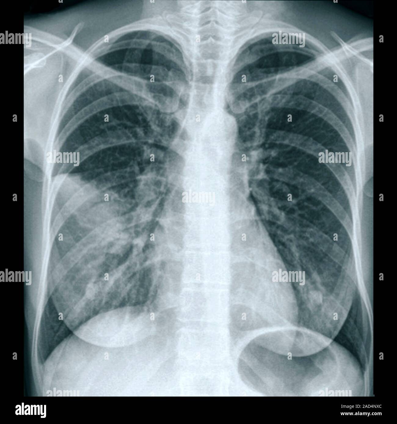 Poumons Dans la pneumonie. Radiographie de la frontale d'un 38-year-old ...