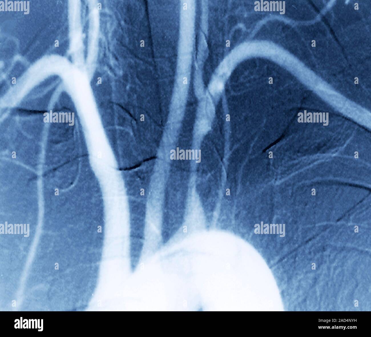 Artère rétrécie. Une section de l'angiogramme à travers les troncs ...