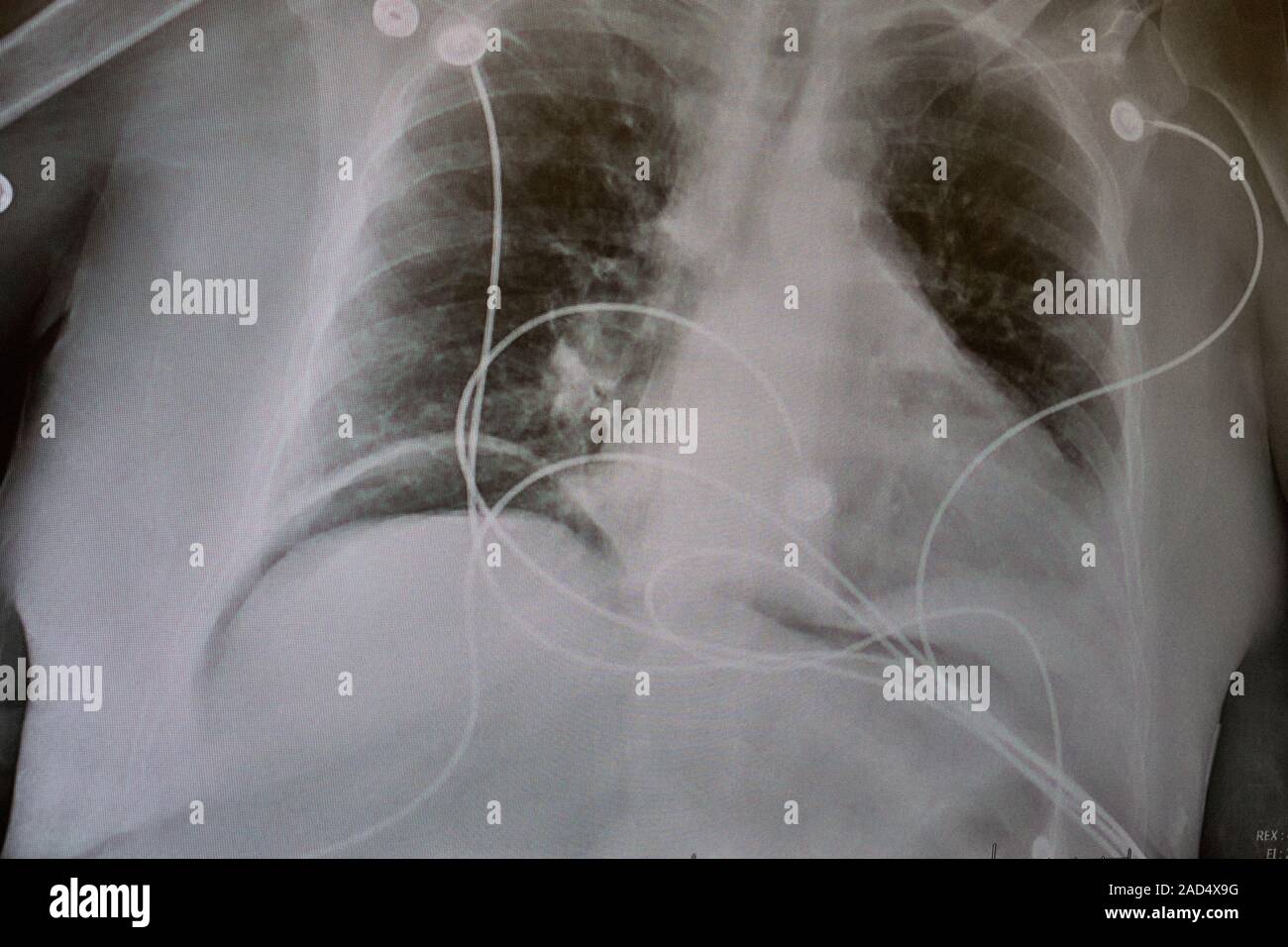 Un pneumopéritoine. Rx thorax montrant le gaz sous la partie droite du ...