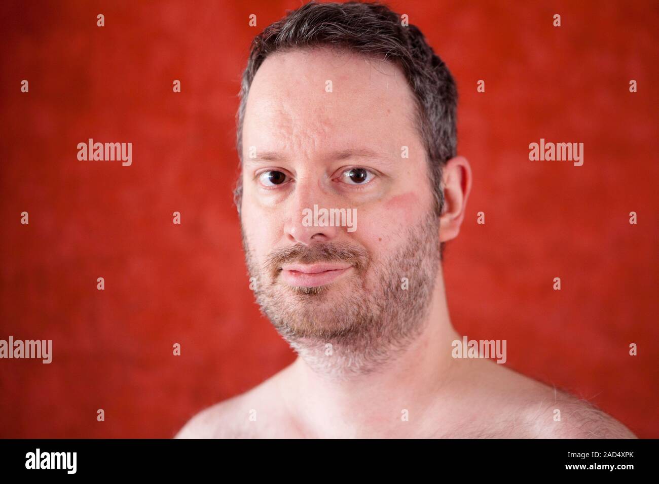 Portrait d'un homme avec la dystrophie musculaire facio-scapulo ...