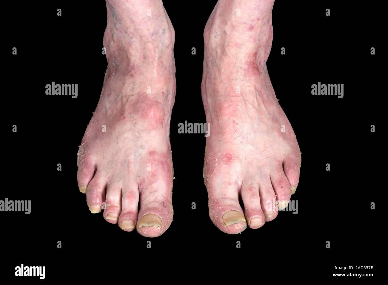 Le psoriasis. Psoriasis affectant les pieds d'un 70-year-old male ...