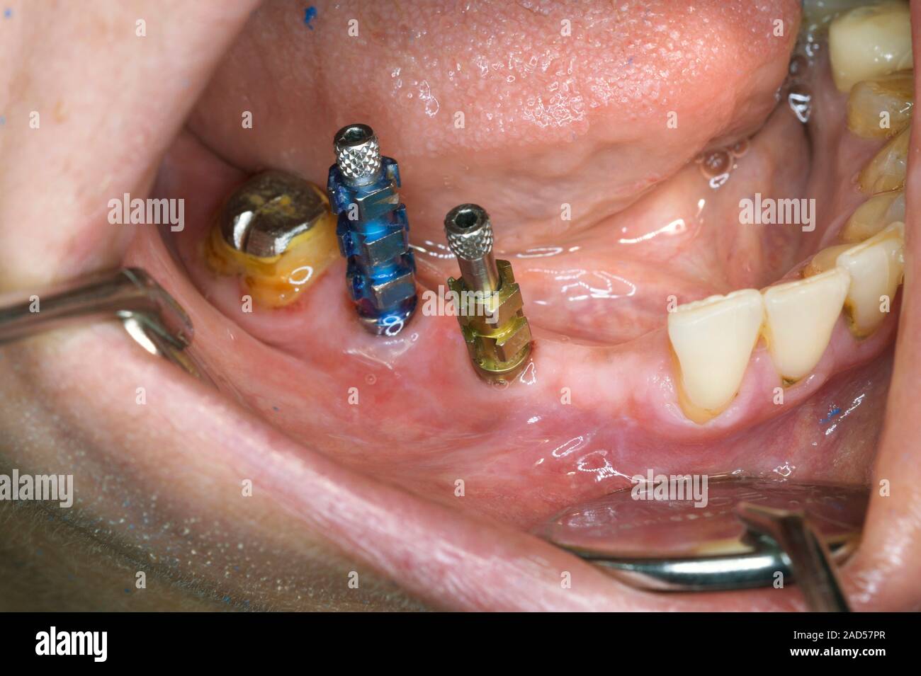 Bridge dentaire préparation. Gros plan de la bouche d'un vieux de 50 ...