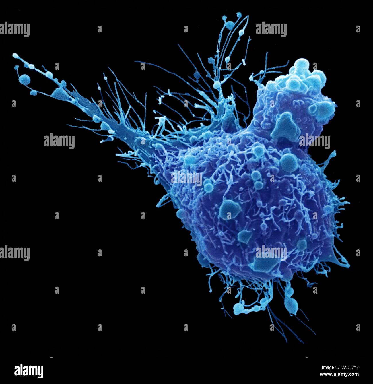 Des cellules de cancer de la vessie. Couleur de l'analyse des électrons ...