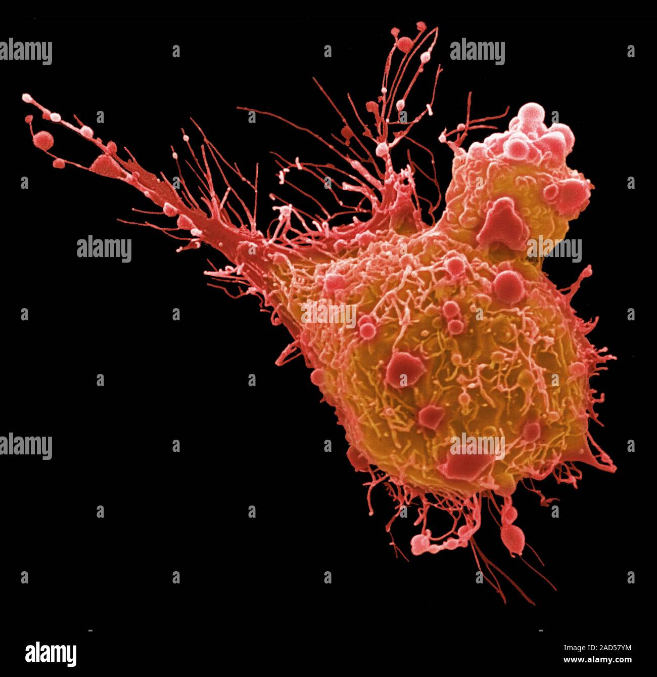 Des cellules de cancer de la vessie. Couleur de l'analyse des électrons ...