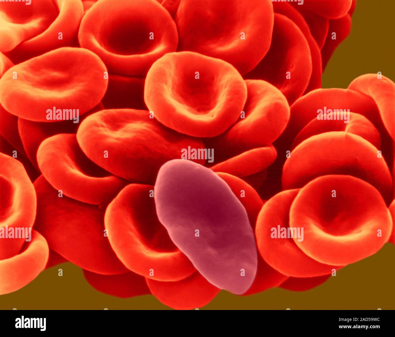 La drépanocytose (cellules sanguines, cellules oblongue conique) entre ...