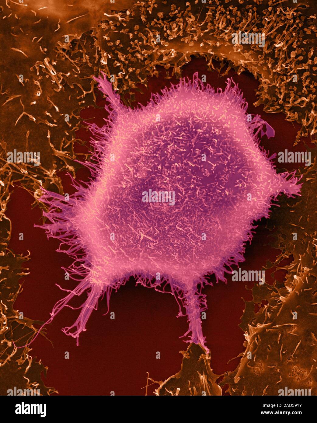 Les cellules de cancer épithélial pulmonaire chez les cellules ...