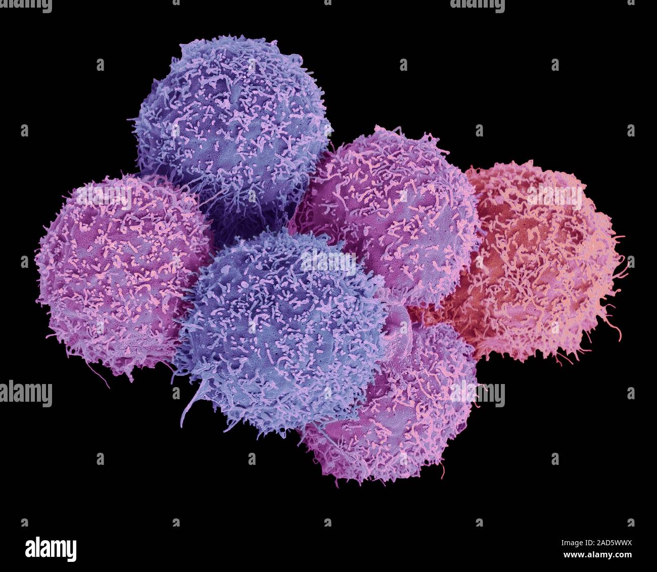 Les cellules de cancer de la vessie. Couleur de l'analyse des électrons ...