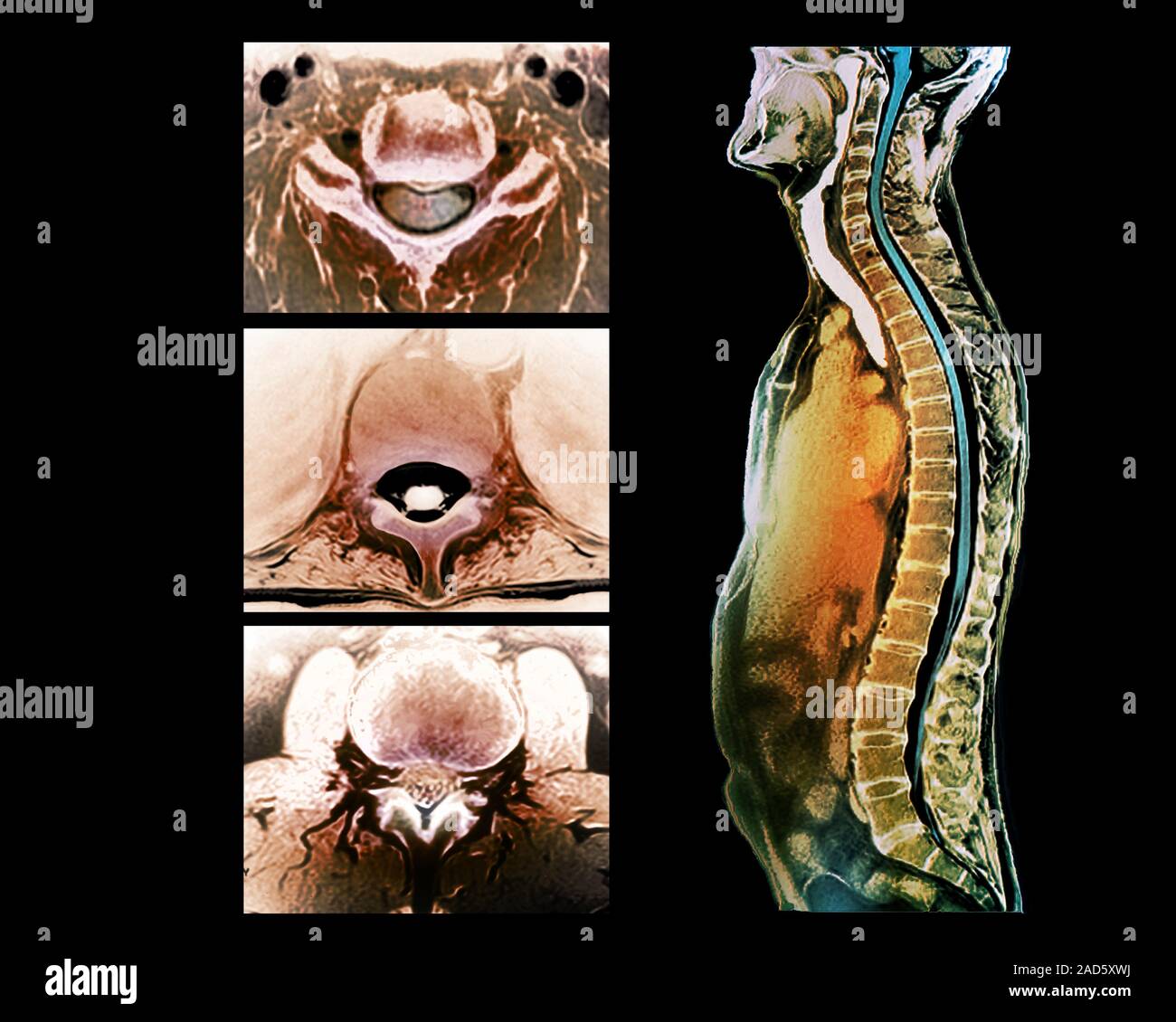 Colonne vertébrale et de la moelle épinière anatomie. L'imagerie par ...