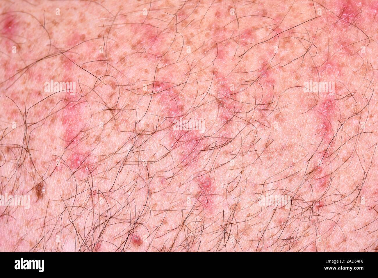 Dermatographic urticaire vasculaire. Close-up d'un dermatographic (peau ...