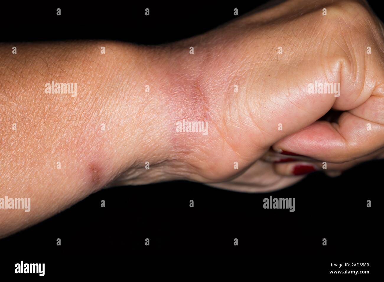 La leishmaniose cutanée Lésion sur un poignet du patient, close-up. Cet ...