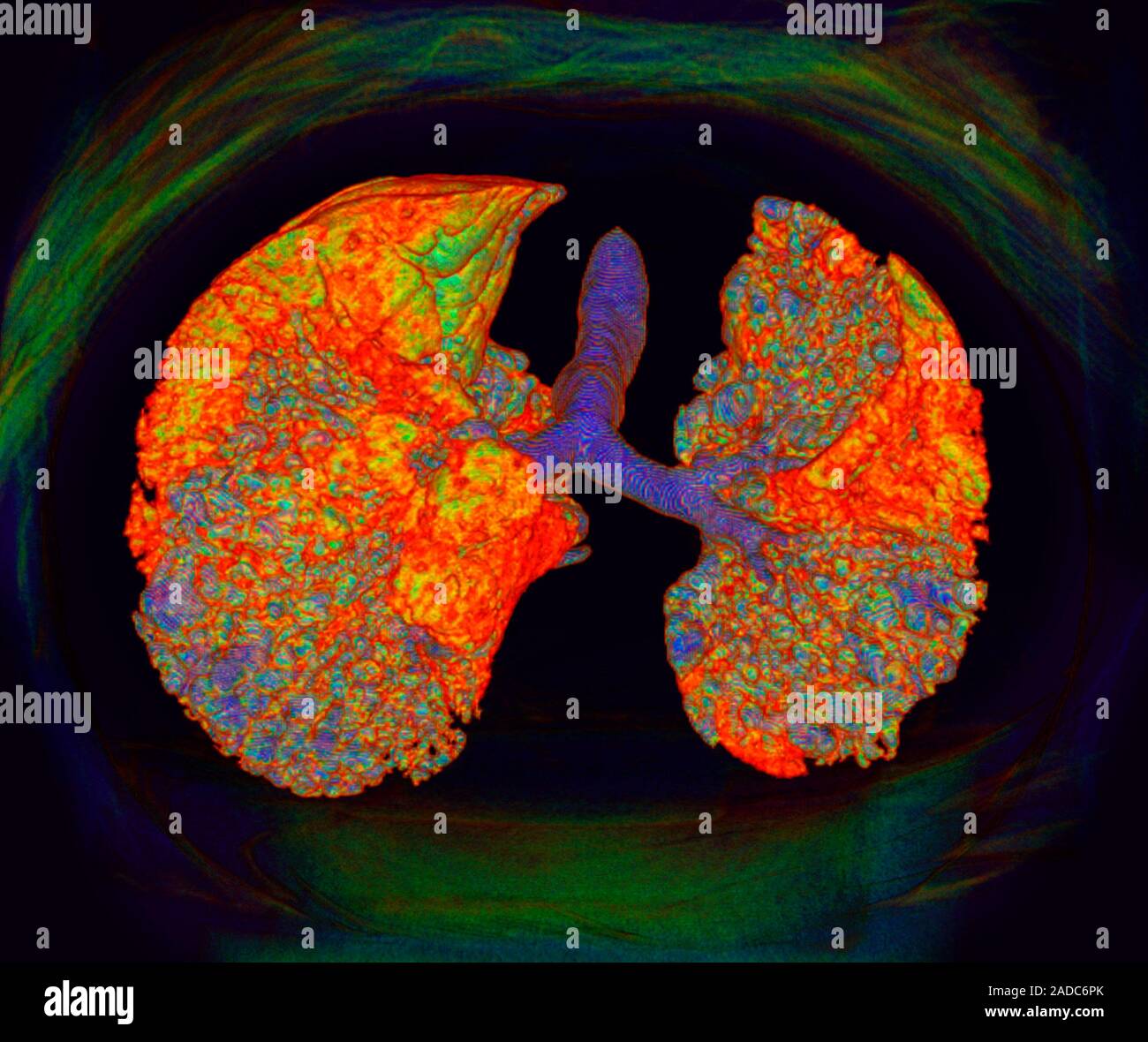 Maladie pulmonaire interstitielle avec fibrose pulmonaire. 3D amélioré ...