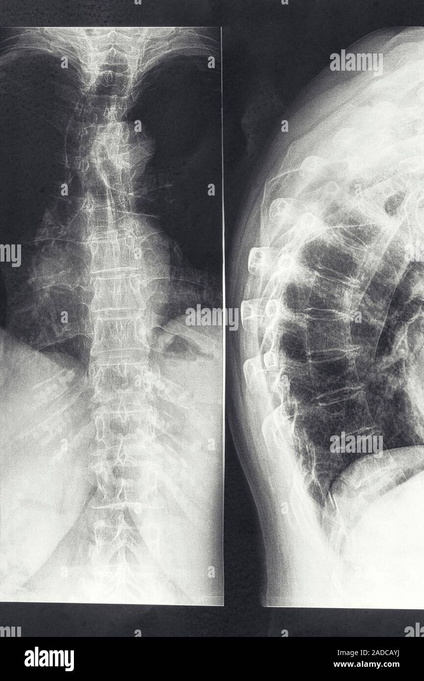 X-ray de la colonne vertébrale d'une jeune femme de 72 ans avec deux ...