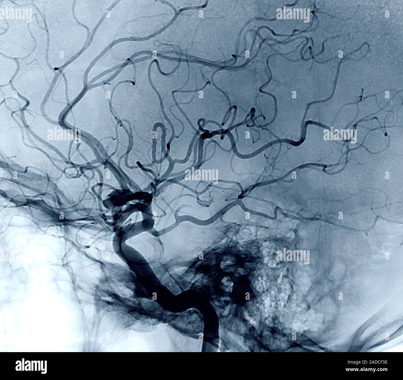 L'anévrisme cérébral. Angiogramme (vaisseau sanguin X-ray) du cerveau ...