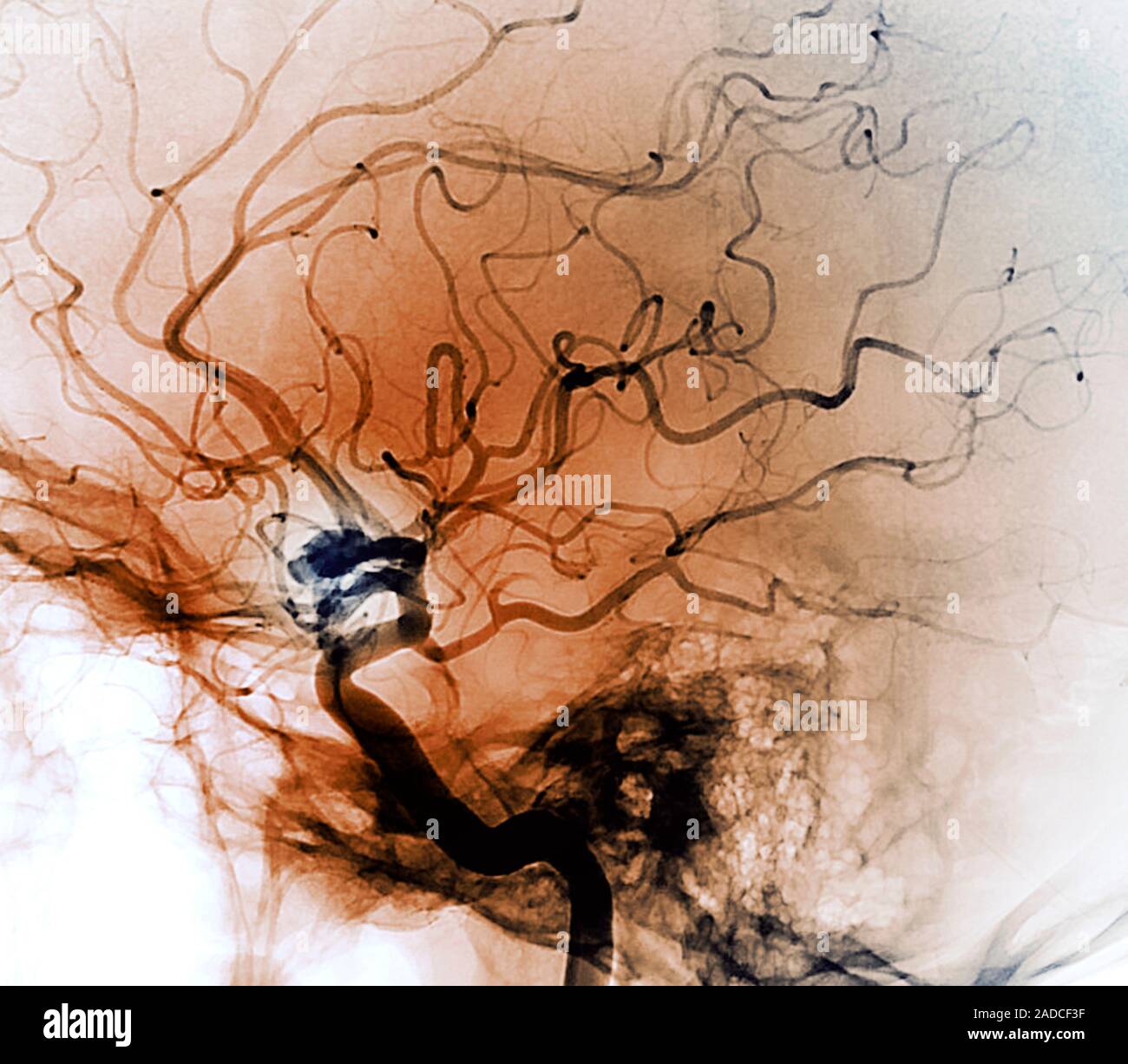 L'anévrisme cérébral. Angiogramme de couleur (vaisseau sanguin X-ray ...