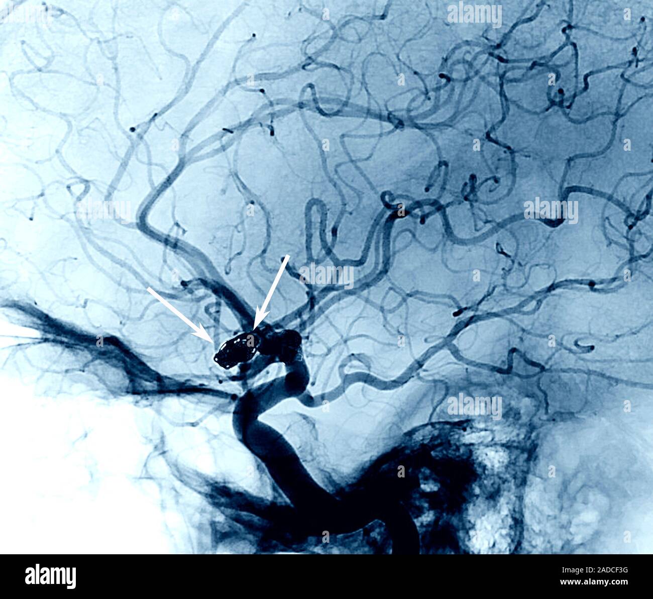 Traitement anévrisme cérébral. Angiogramme (vaisseau sanguin X-ray) du ...