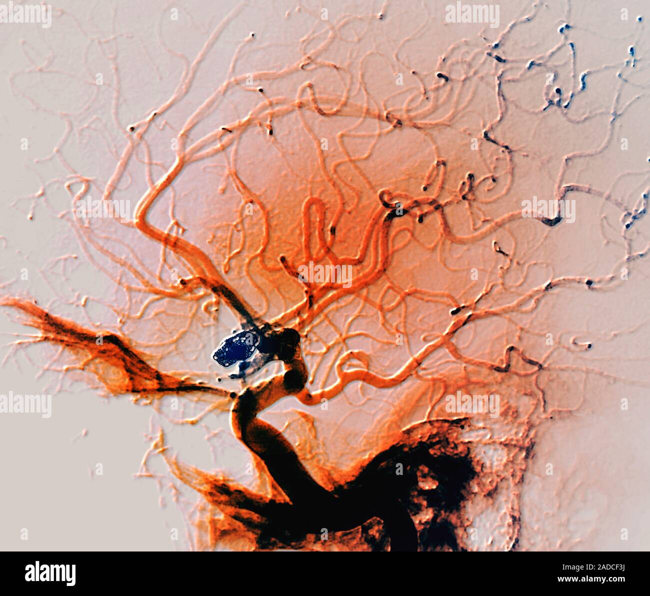 Traitement anévrisme cérébral. Angiogramme de couleur (vaisseau sanguin ...
