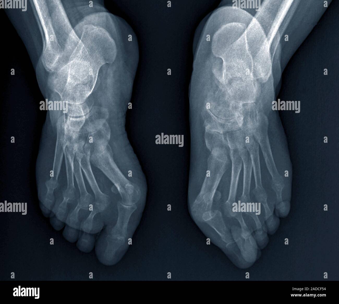 La polyarthrite rhumatoïde des pieds. Des radiographies bilatérales des ...