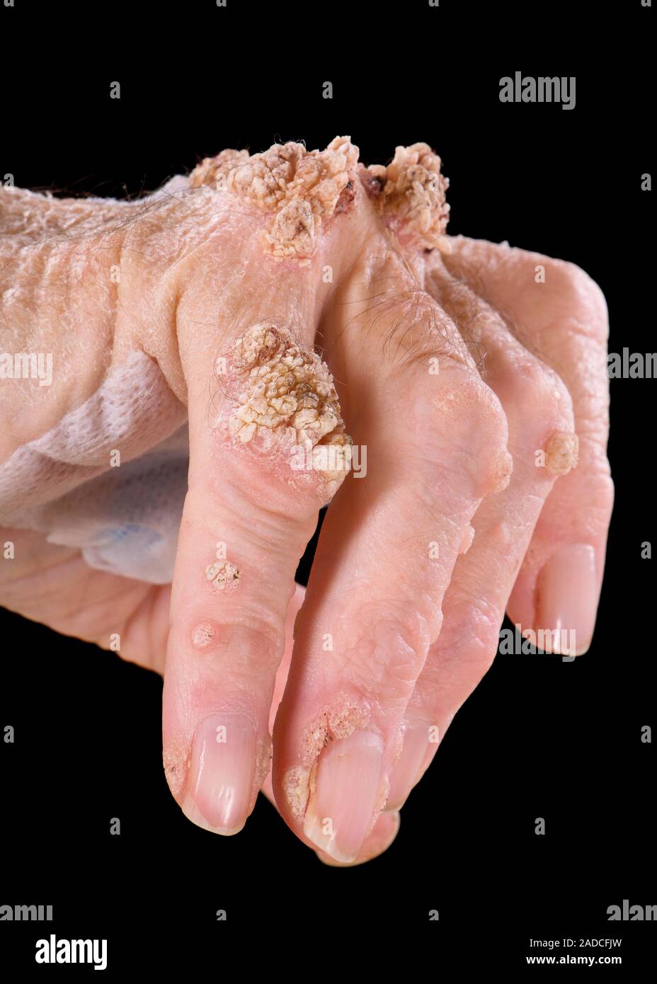 Les lésions squameuses proliférative sur la main d'une femme de 51 ans ...