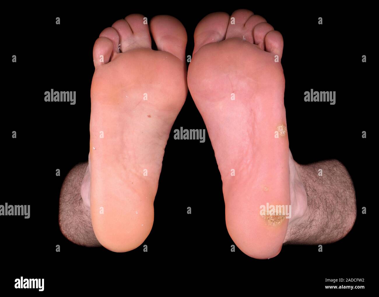 Verrues communes (verruca vulgaris) sur les pieds d'un homme de 22 ans ...