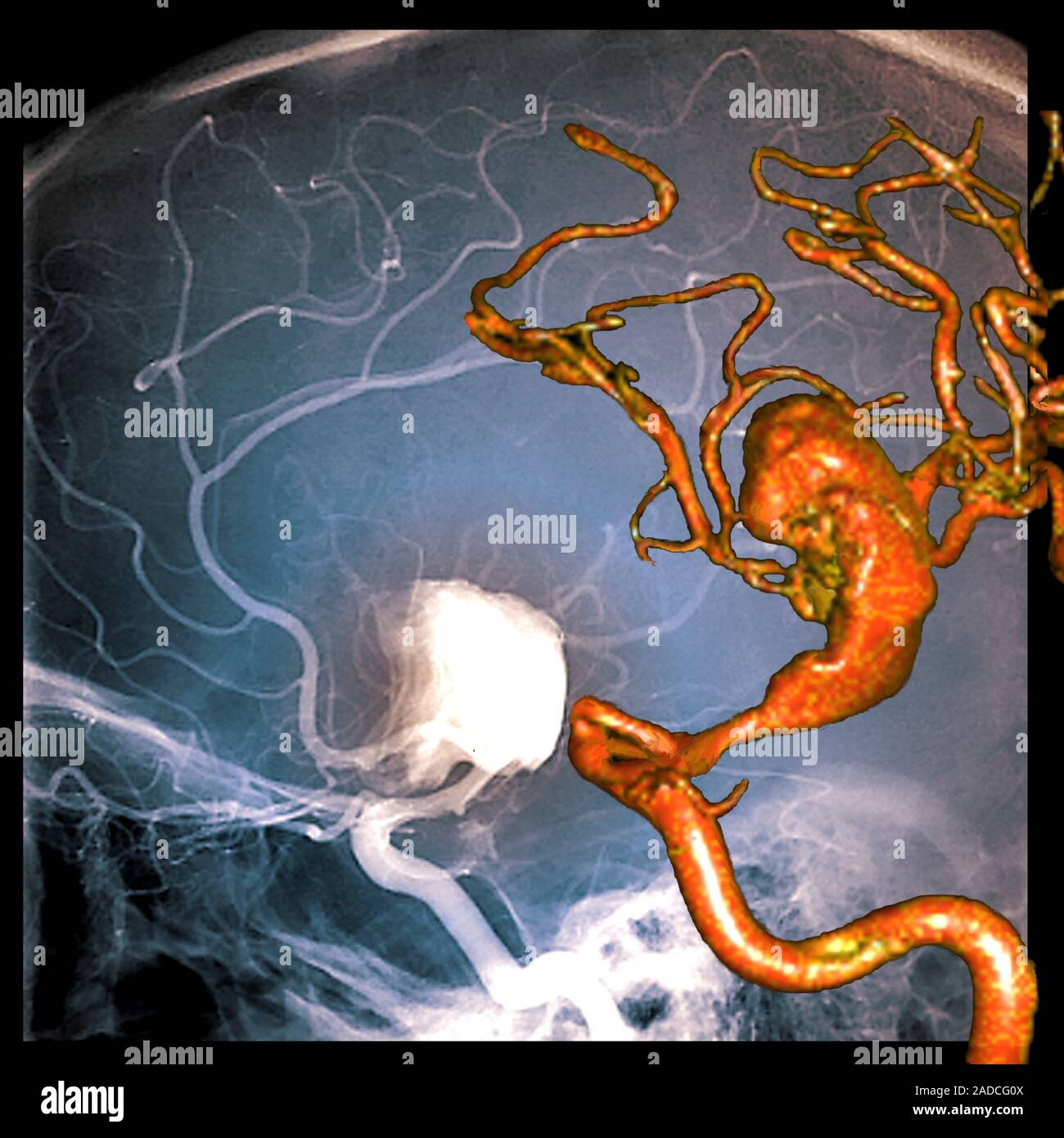 L'anévrisme cérébral. Angiogramme de couleur (vaisseau sanguin X-ray ...