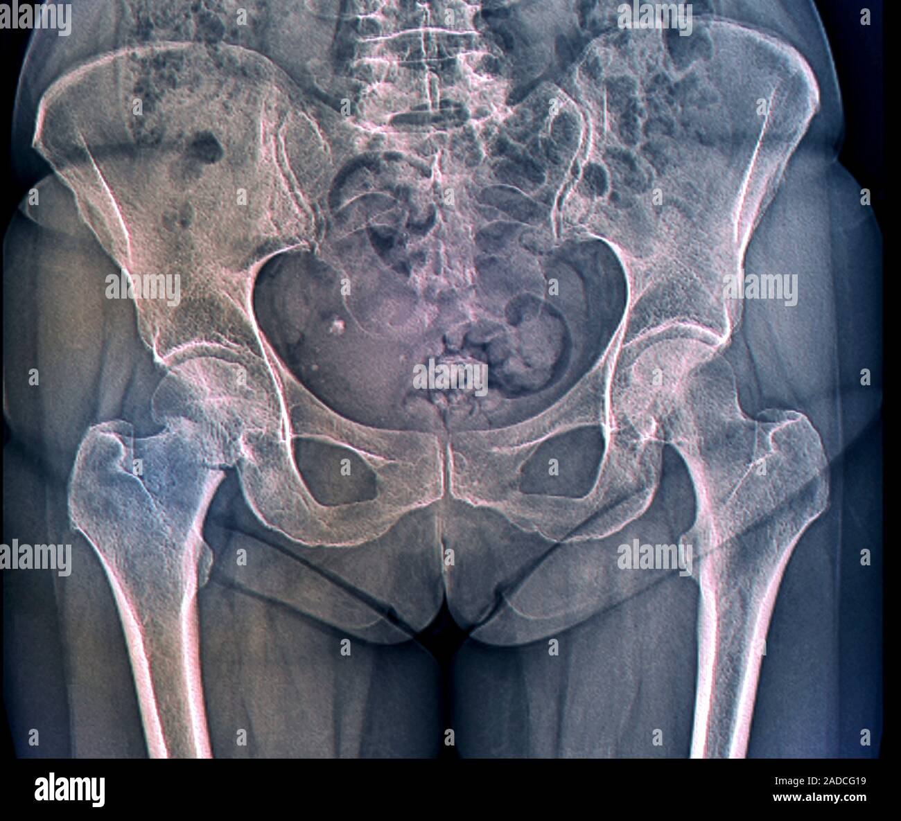 Fracture de la hanche. Frontal couleur radiographie de la région ...