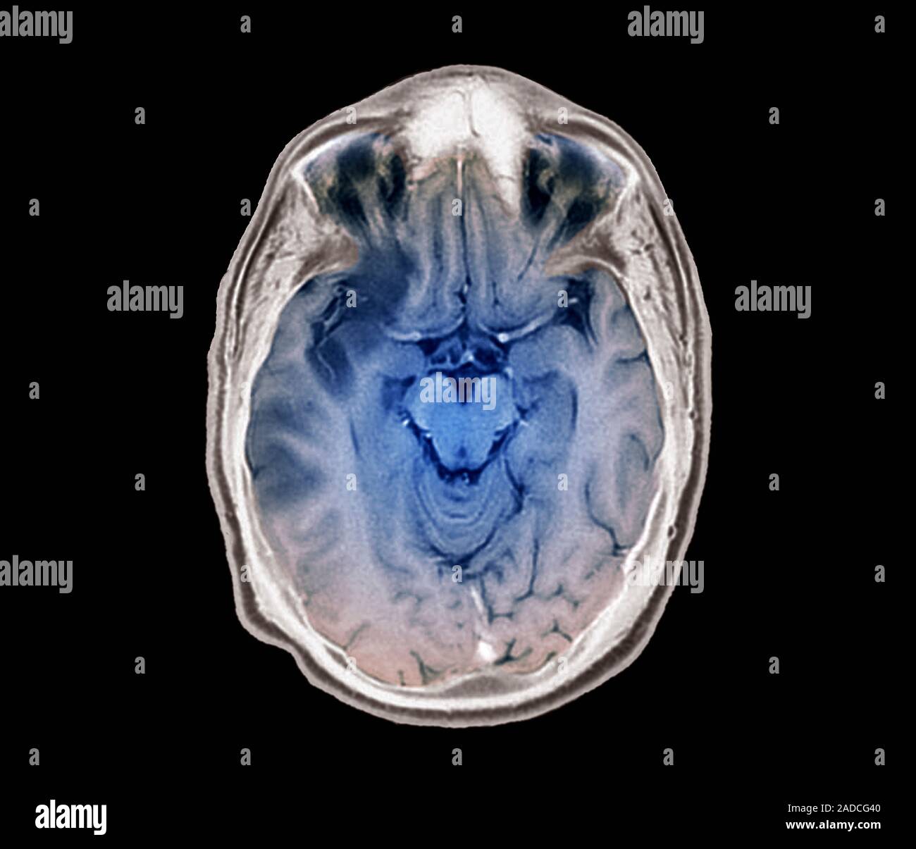 Les accidents vasculaires cérébraux. Axial de couleur l'imagerie par ...