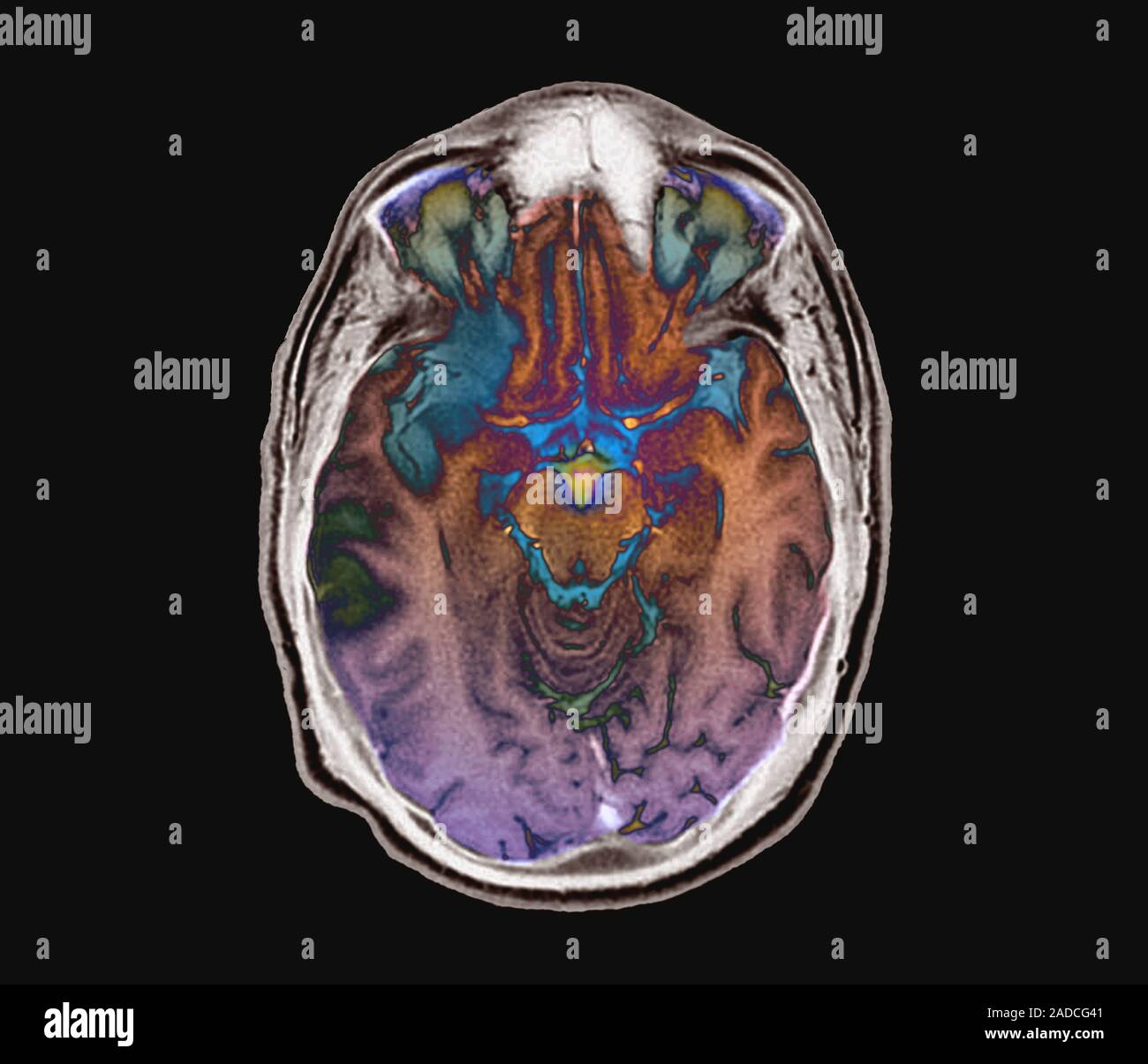 Les accidents vasculaires cérébraux. Axial de couleur l'imagerie par ...