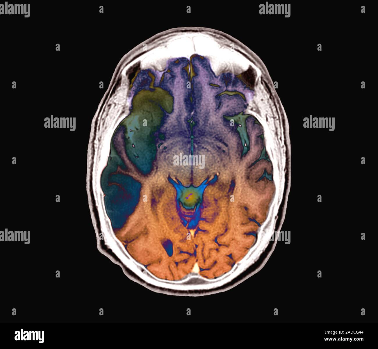 Les accidents vasculaires cérébraux. Axial de couleur l'imagerie par ...