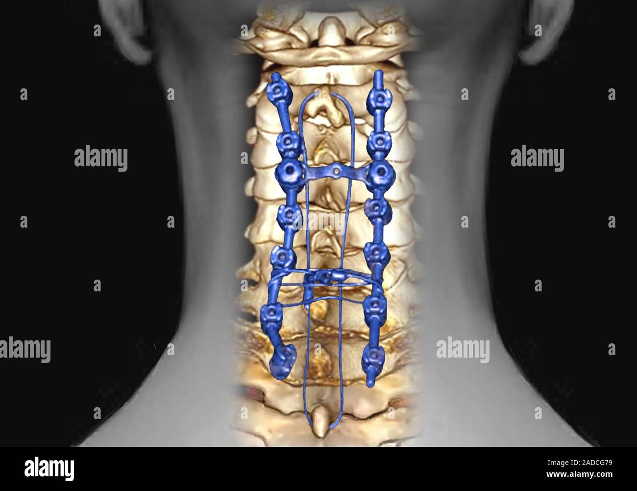 Le tombé sur vertèbres du cou. 3D couleur scanner de l'implants ...