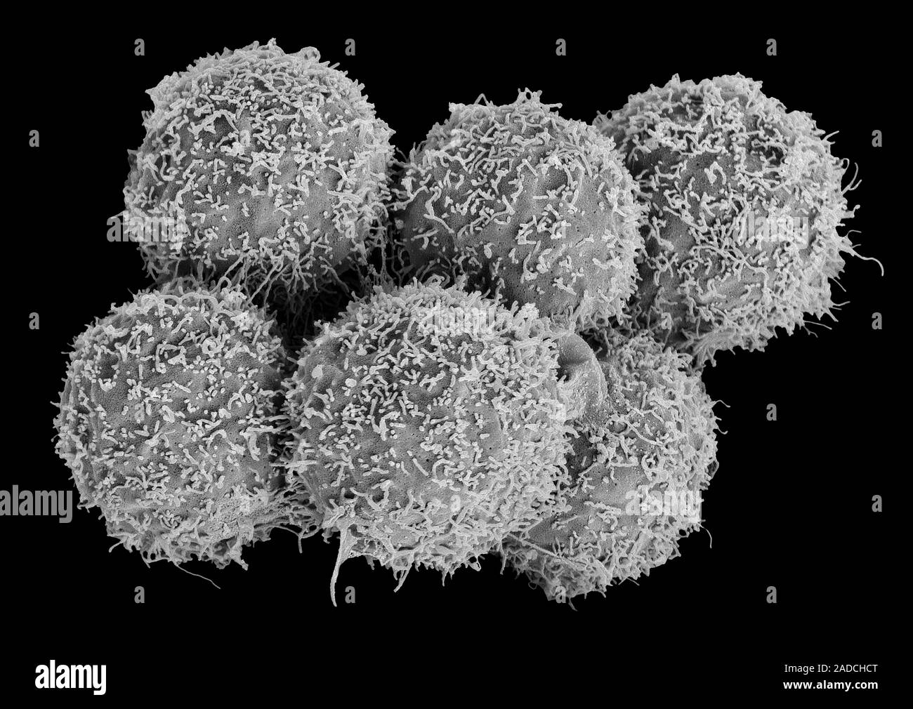 Les cellules de cancer de la vessie. L'analyse des électrons ...
