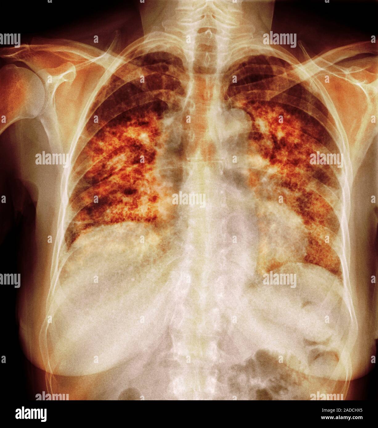 La fibrose pulmonaire. X-ray de couleur montrant les poumons d'une ...