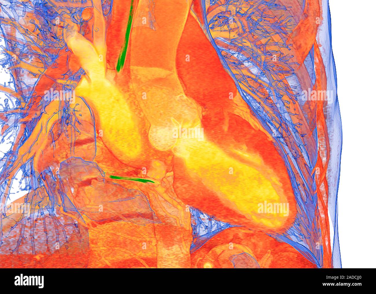Coeur et ventricule gauche avec stimulateur cardiaque, de couleur 3D ...