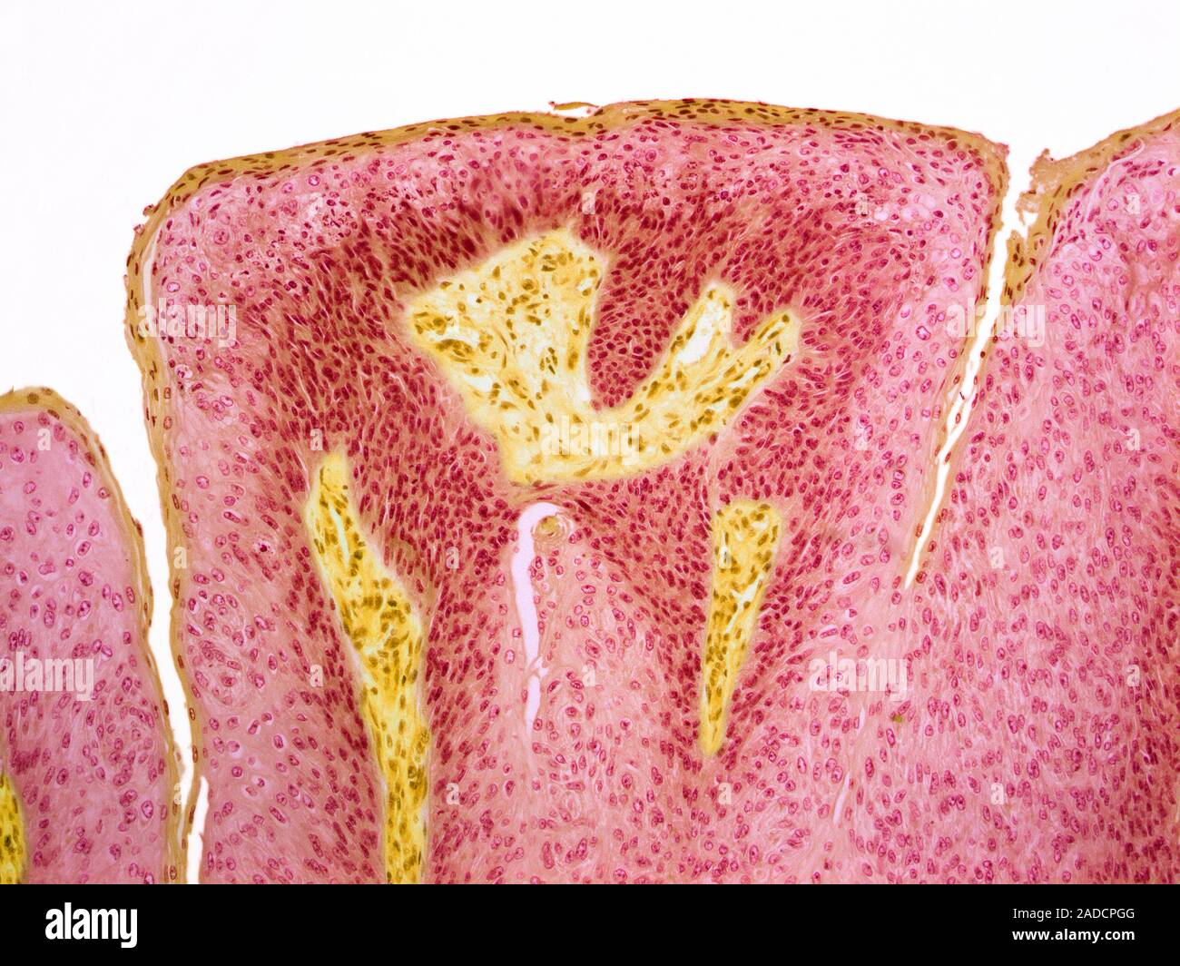 Des verrues génitales. La lumière microphotographie (LM) d'une section ...