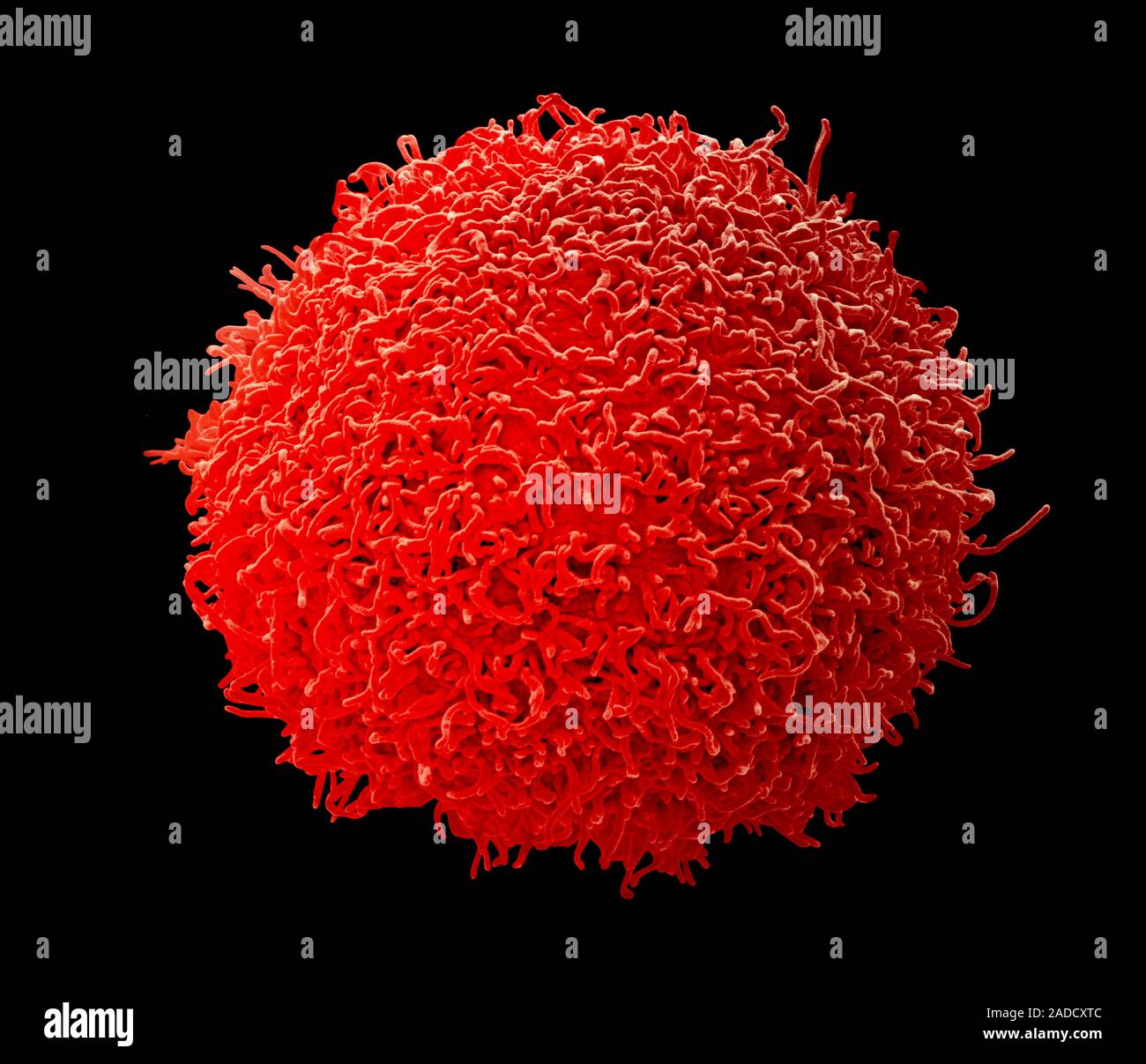 Les cellules du cancer du rein. Couleur de l'analyse des électrons ...